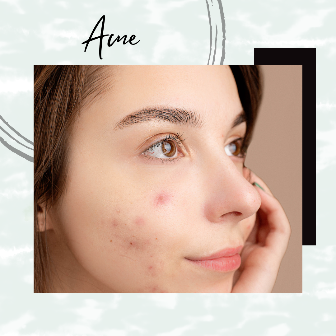 Understanding Acne: An Esthetician's Guide to Clearer Skin - The Body ...
